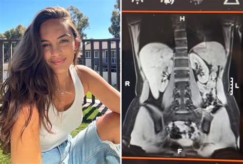 Woman Shares Mri Scan To Prove How Contraceptive Pill Gave Her Two