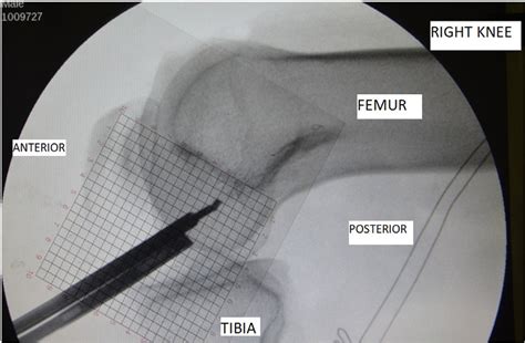 Intraoperative Fluoroscopy Image Of Lateral View Of The Right Knee With