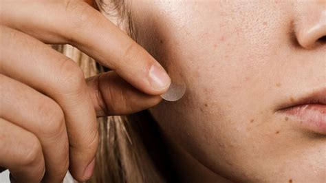 What Are Pimple Patches Do They Really Work Professional Beauty