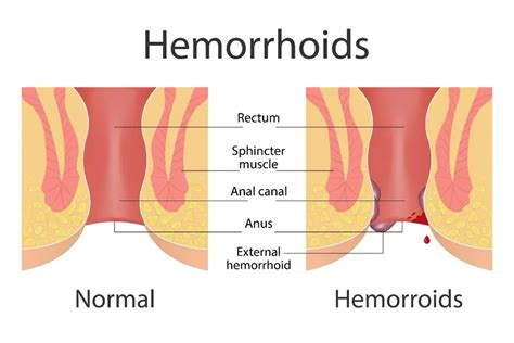 Hemorrhoid Ablation Gastroenterologist In Forest Hills Ny Forest