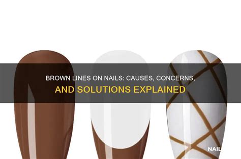 Brown Lines On Nails Causes Concerns And Solutions Explained Nailicy