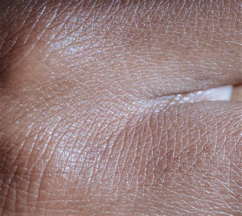 Christmas Tree Shaped Rash On Back At Mackenzie Boehm Blog