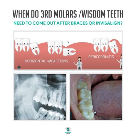 Do 3rd Molars Or Wisdom Teeth Need To Come Out After Braces Or Invisalign