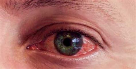 Conjuntivite Alergica Como Prevenir A Conjuntivite Neooftalmo