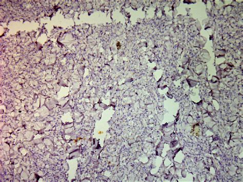Anaplastic Lymphoma Kinase Alk Negative Systemic Anaplastic Large Cell Lymphoma Presenting As
