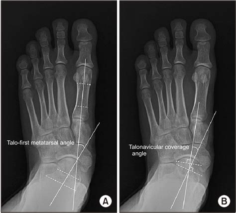 The Anteroposterior Weight Bearing Radiograph Of The Foot Showed The Download Scientific