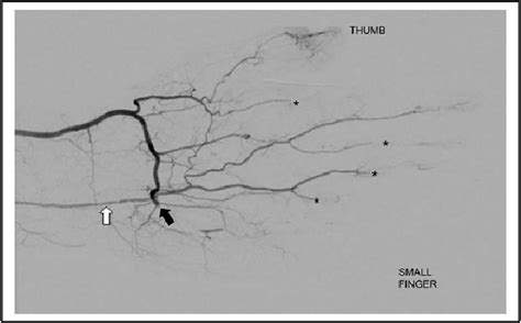 Figure 3 From Microvascular Hand Surgery For Digital Ischemia In