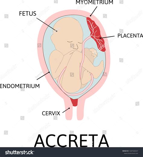 Placenta Accreta Part Placenta Attaches Abnormally Stock Vector