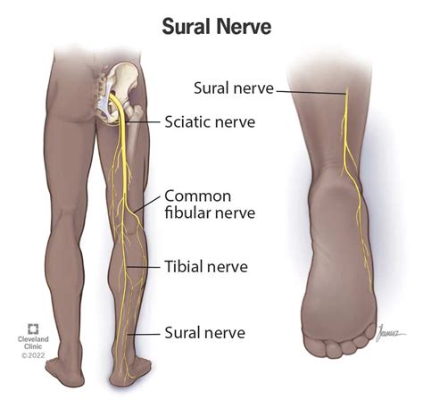 Common Peroneal Neuropathy