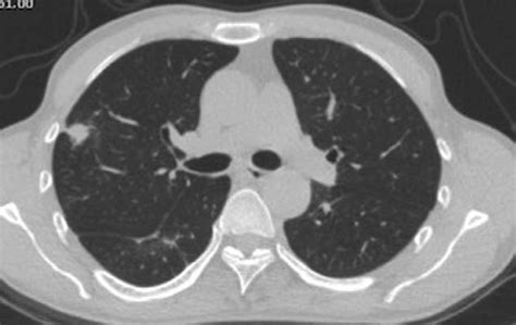 Representative Case With Pulmonary Cryptococcosis Showed A Nodule