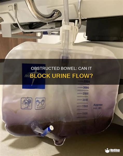 Obstructed Bowel Can It Block Urine Flow Medshun