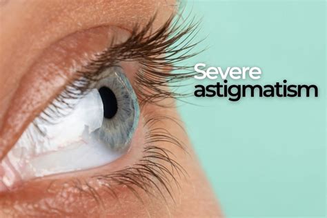 Severe Astigmatism What Can Be Done To Correct It Ezontheeyes