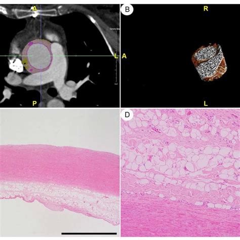 Adventitial Fibrosis Grade 2 This Index Case Refers To A 69 Year Old