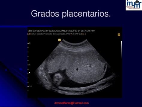 Ultrasonido En La Evaluacion Placentaria Dr Romel Imumr