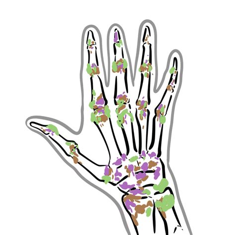 Caplan Syndrome Armando Hasudungan
