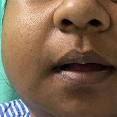 Secrets To A Successful Awake Fibreoptic Intubation Afoi On A Patient With Odentogenous