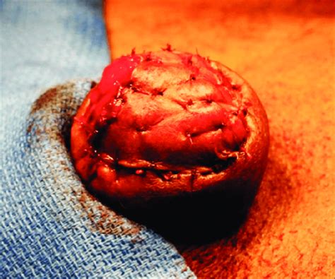 Patient After Partial Penectomy Split Thickness Skin Graft Used For