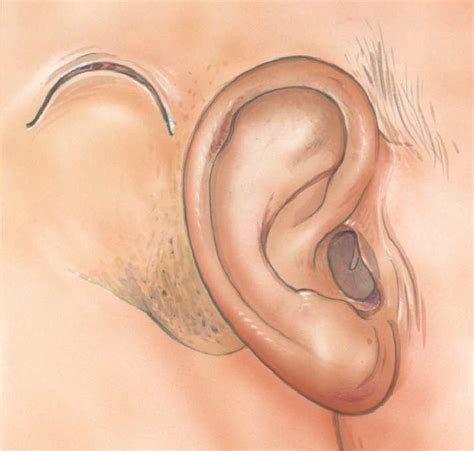 Second Temporal Incision To Create The Well For The Cochlear Implant Download Scientific