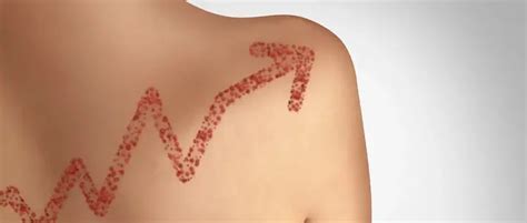 如何应对靶向治疗中的皮疹 知乎