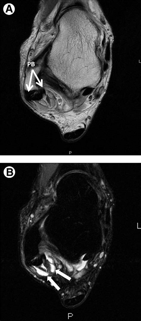 Peroneal Brevis Split Tear The Peroneal Brevis Pb Has Separated Into Download Scientific