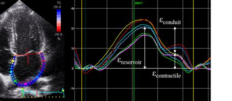 Left Atrial Speckle Tracking Strain Analysis Speckle Tracking Strain