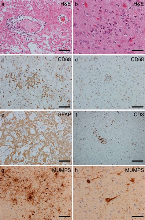 Deep Sequencing Reveals Persistence Of Cell Associated Mumps Vaccine