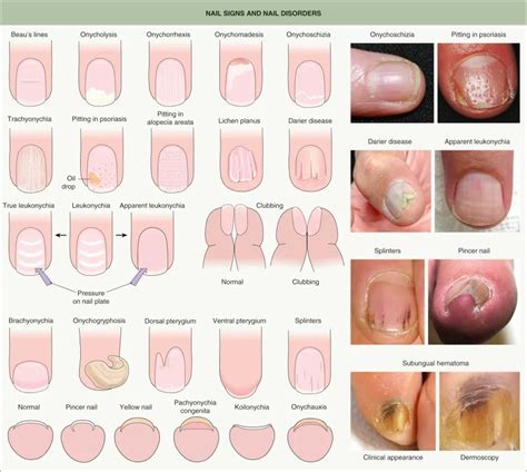 Fingernail Disorders Symptom