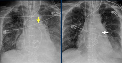 The Radiology Assistant Cardiovascular Devices