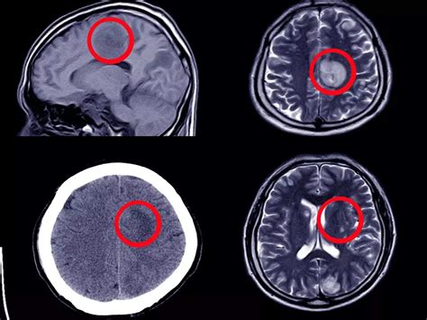 7 Signs Of A Brain Aneurysm That Are Often Ignored Vipdailygagme