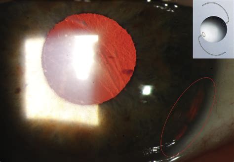 Iris Transillumination Defects
