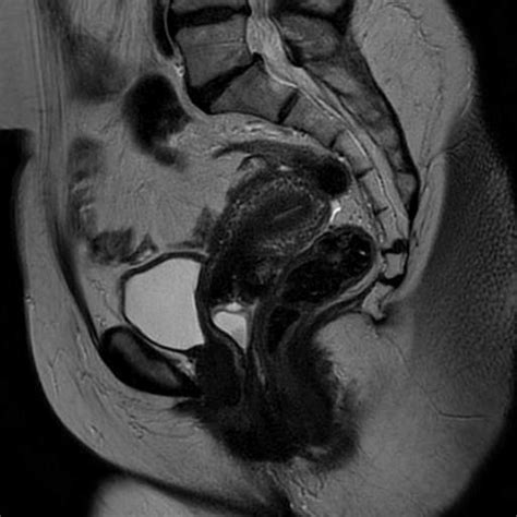 Gartner Duct Cyst Pictures Of S