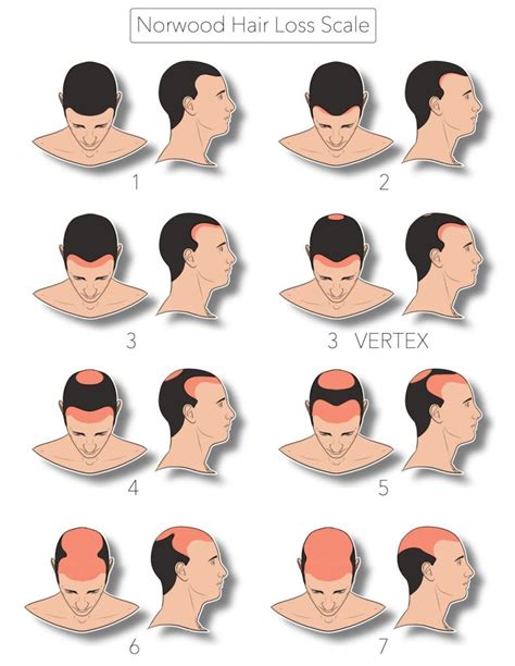 Norwood Hamilton Scale Hair Loss And Treatment Guide