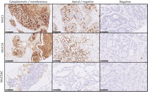 Protein Expression Of Muc1 Top Row Muc16 Middle Row And Muc5ac