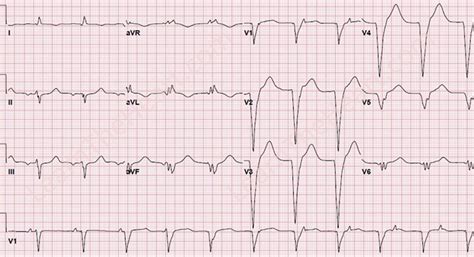Coronary Artery Disease Stemi Topic Review