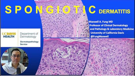 Allergic Contact Dermatitis Histology
