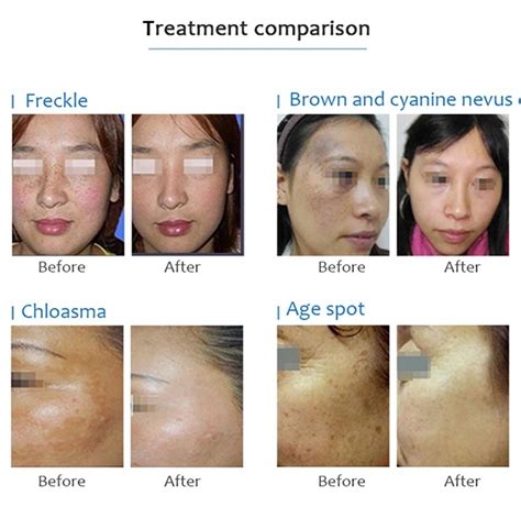 Portable Picosecond Laser For Age Spot And Freckle Removal Honkon Hot