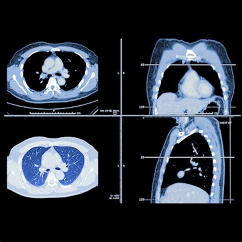 Lung Rads Updates Coming To A Practice Near You Auntminnie