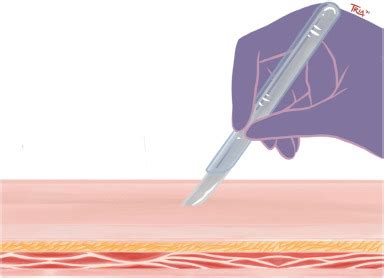 Deconstructing The Steps Of Pull Type Peg Tube Insertion Videogie