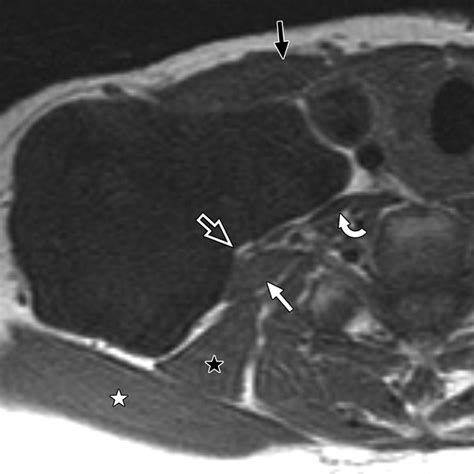 Characteristic Imaging Findings In Lymphoceles Of The Head And Neck Ajr