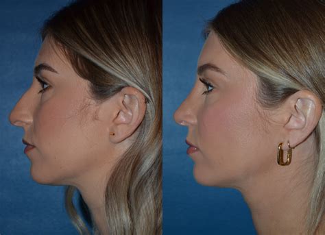 Rhinoplasty Before And After Dr George Miguel
