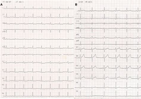 Ultra Early Myocardial Calcification Secondary To Fulminant Myocarditis