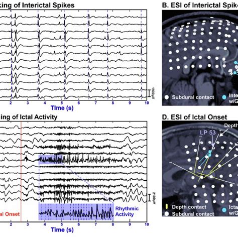 Marking And Esi Of Interictal And Ictal Ieeg A Example Of Ieds