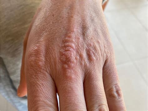 Maculopapular Rash Hands