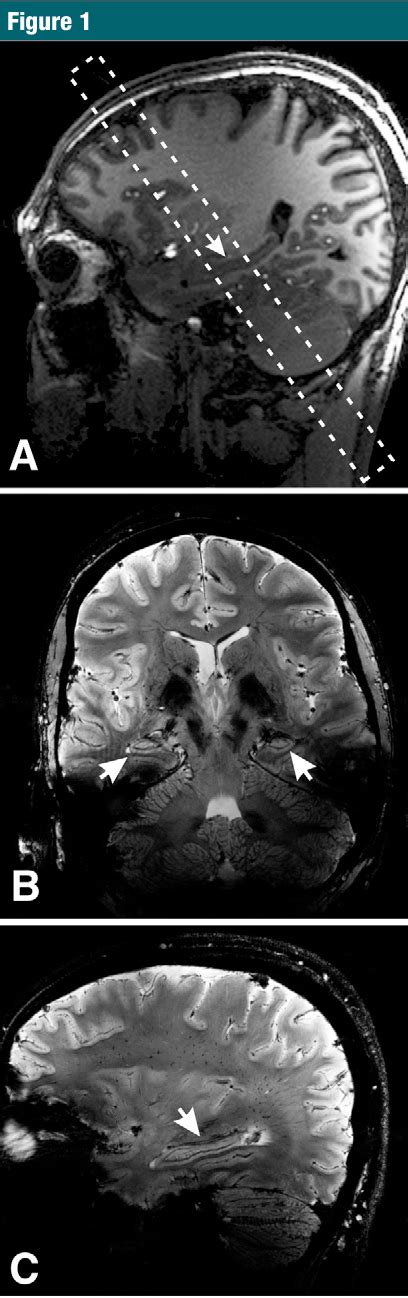 Figure 1 From Human Hippocampal Subfields In Young Adults At 70 T