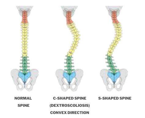 How To Fix S Shaped Spine At Alice Wollstonecraft Blog