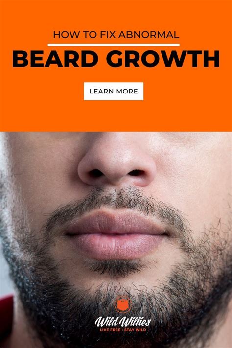 7 Common Reasons Behind Your Patchy Beard Find Your Patchy Beard Fix