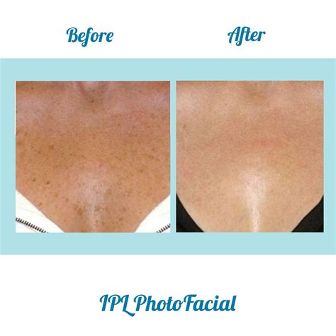 Best Ipl Photofacial Bella Medspa Buckhead And Alpharetta