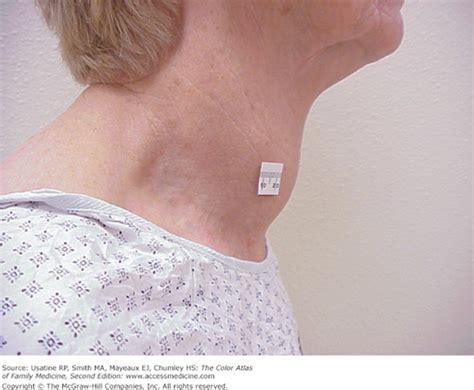 Goitrous Hypothyroidism Basicmedical Key