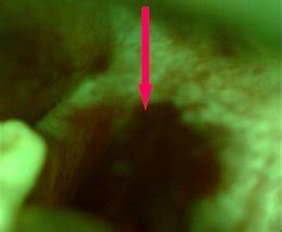 Velscope Enhanced Oral Cancer Exam Dental Arts Group