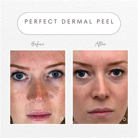 Perfect Dermal Peel Skin Refinement Aspire Care Clinic Chemical